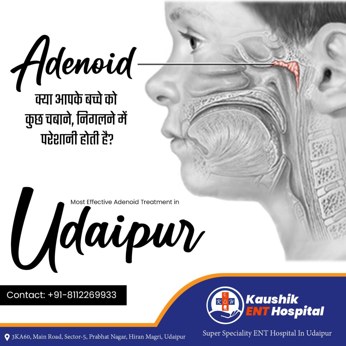 Adenoid surgery in Udaipur - Kaushik ENT Hospital