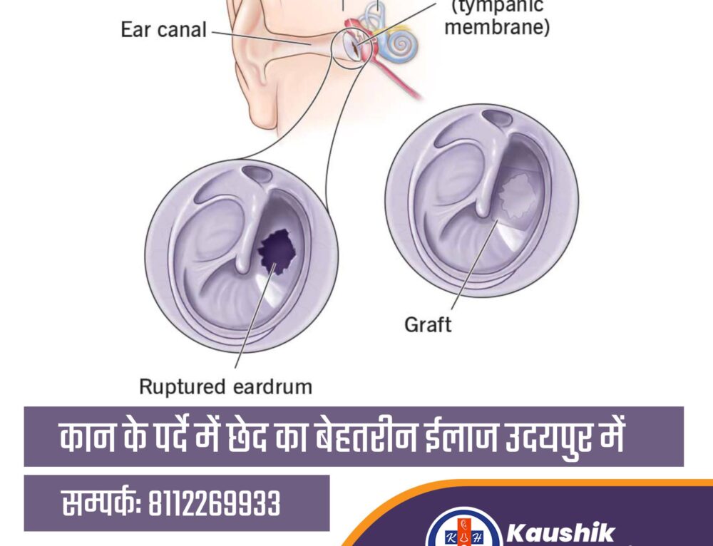 Tympanoplsty Surgery in Udaipur | Explained in Hindi – Kaushik ENT Hospital
